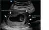 Subchorionic bleed,10 week pregnancy - Critical Care Sonography