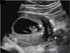 Subchorionic bleed,10 week pregnancy - Critical Care Sonography