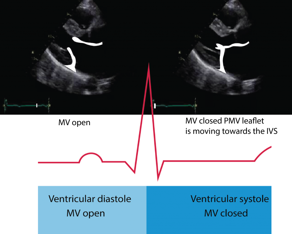 Shock - Left Ventricular Outflow Obstruction - Critical Care Sonography