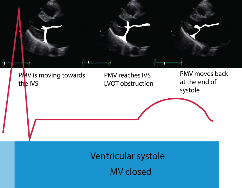 Shock - Left Ventricular Outflow Obstruction - Critical Care Sonography