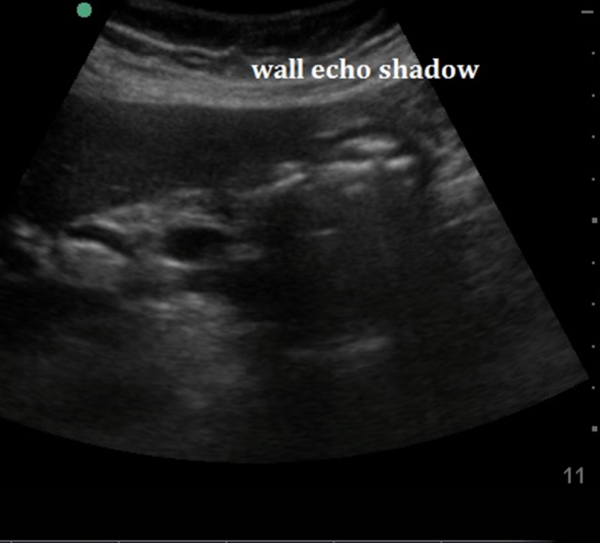 Wall Echo Shadow - Critical Care Sonography
