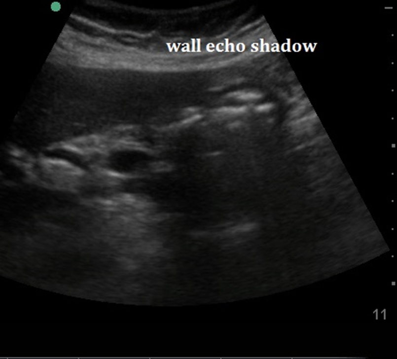 Wall Echo Shadow - Critical Care Sonography