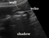 Wall Echo Shadow - Critical Care Sonography