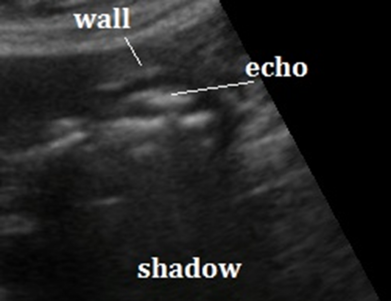 Wall Echo Shadow - Critical Care Sonography
