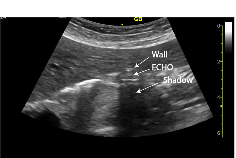 Wall Echo Shadow - Critical Care Sonography