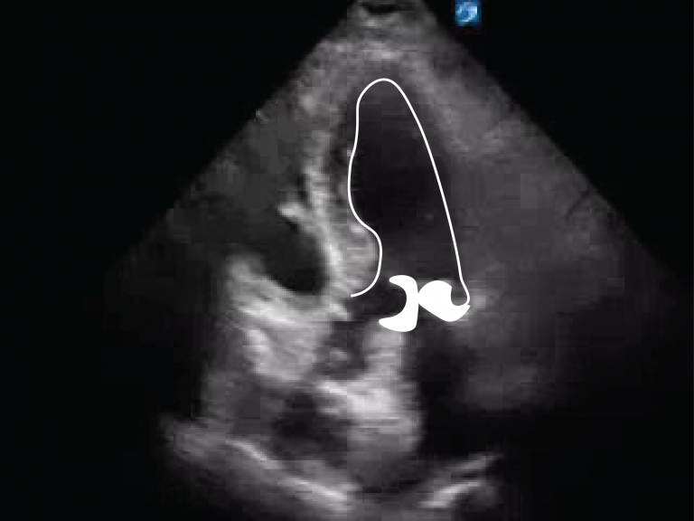 Systolic anterior motion SAM - Critical Care Sonography