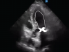 Systolic anterior motion SAM - Critical Care Sonography