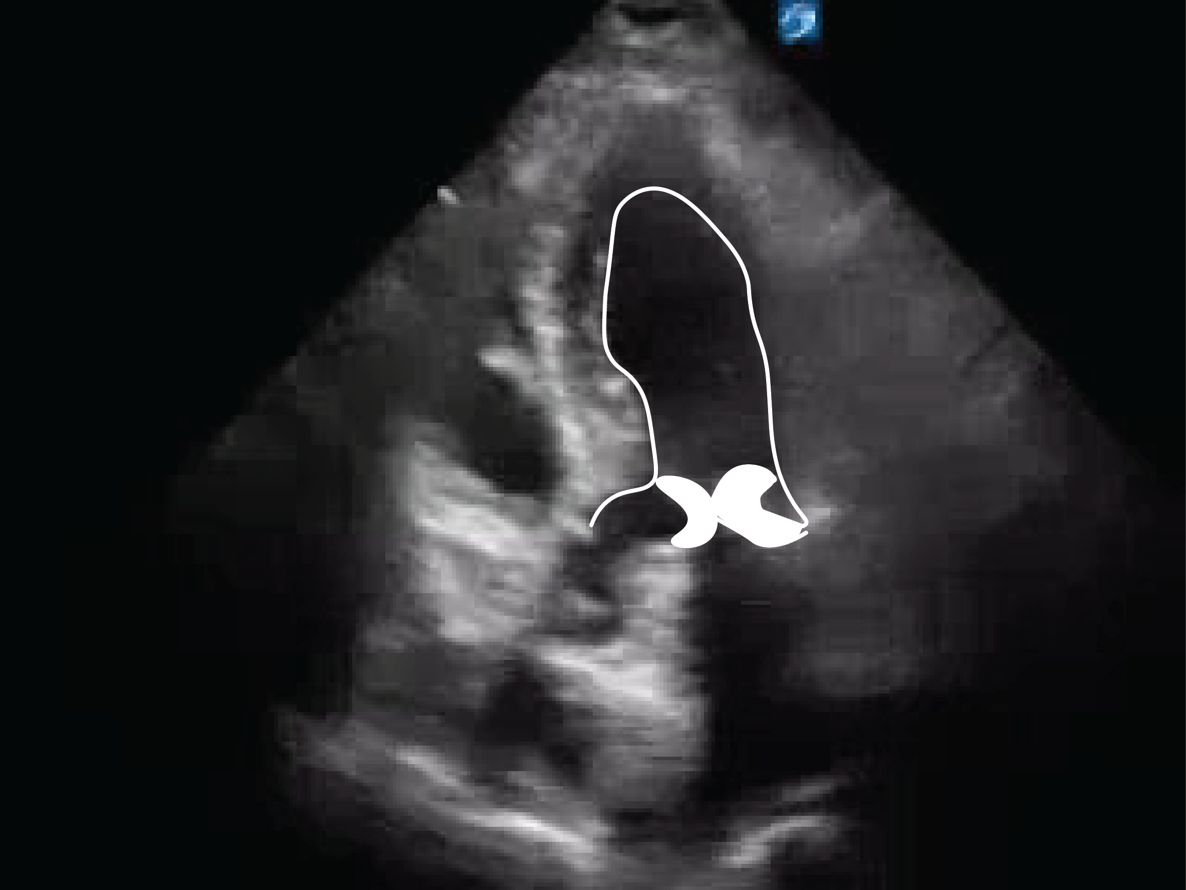 Systolic anterior motion SAM - Critical Care Sonography