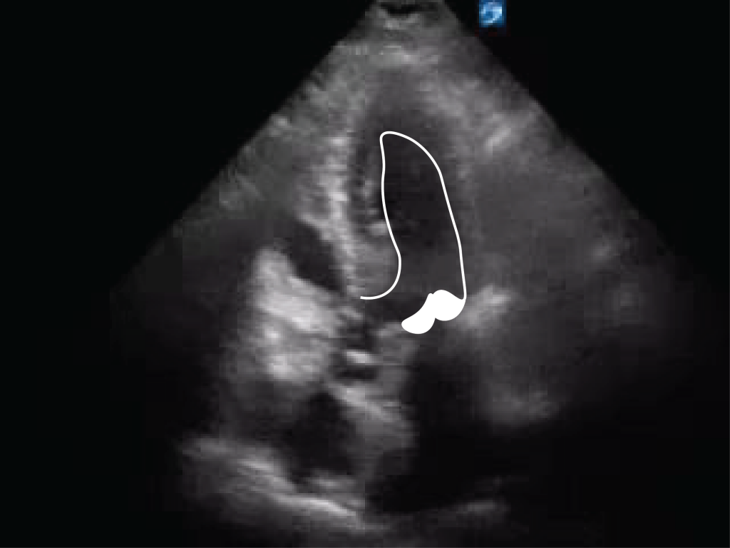 Systolic anterior motion SAM - Critical Care Sonography
