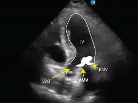 Systolic anterior motion SAM - Critical Care Sonography