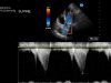 Systolic anterior motion SAM - Critical Care Sonography