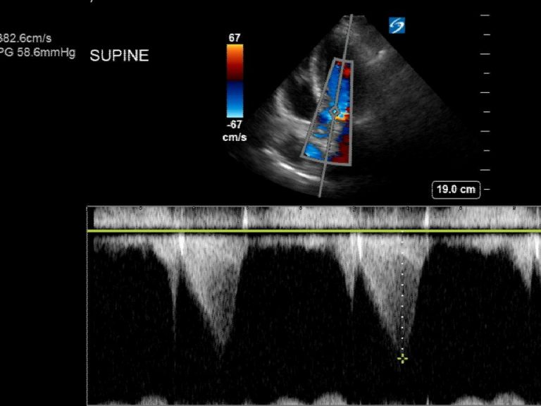 Systolic anterior motion SAM - Critical Care Sonography