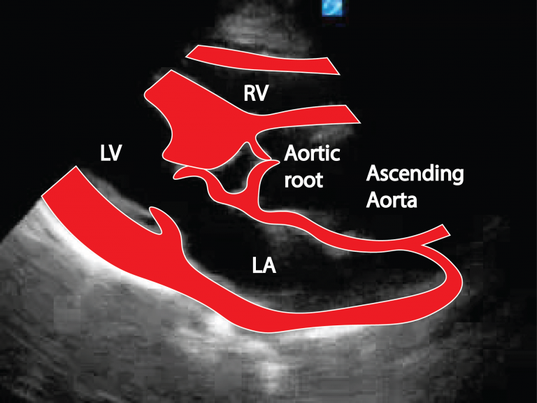 Discovering the aorta through ultrasound - Critical Care Sonography