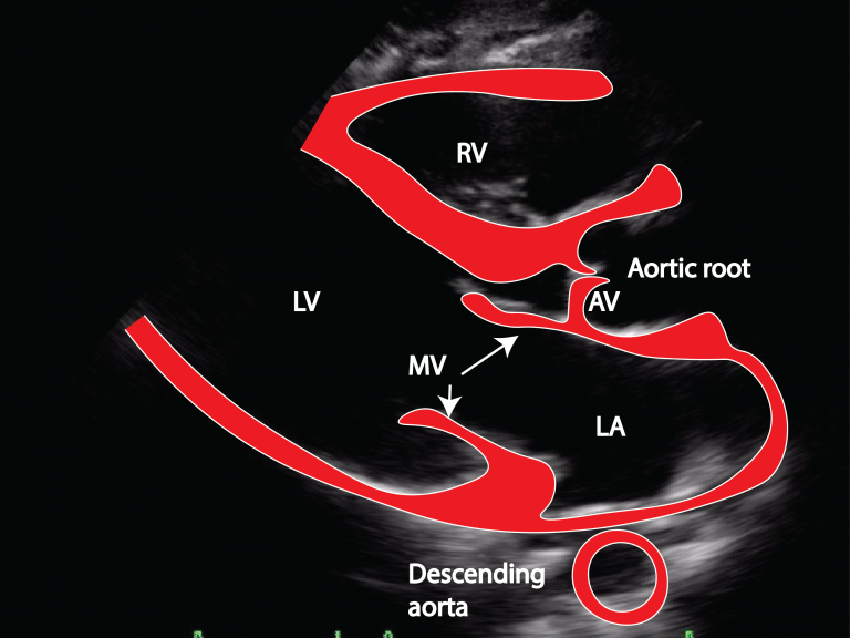 Discovering the aorta through ultrasound - Critical Care Sonography