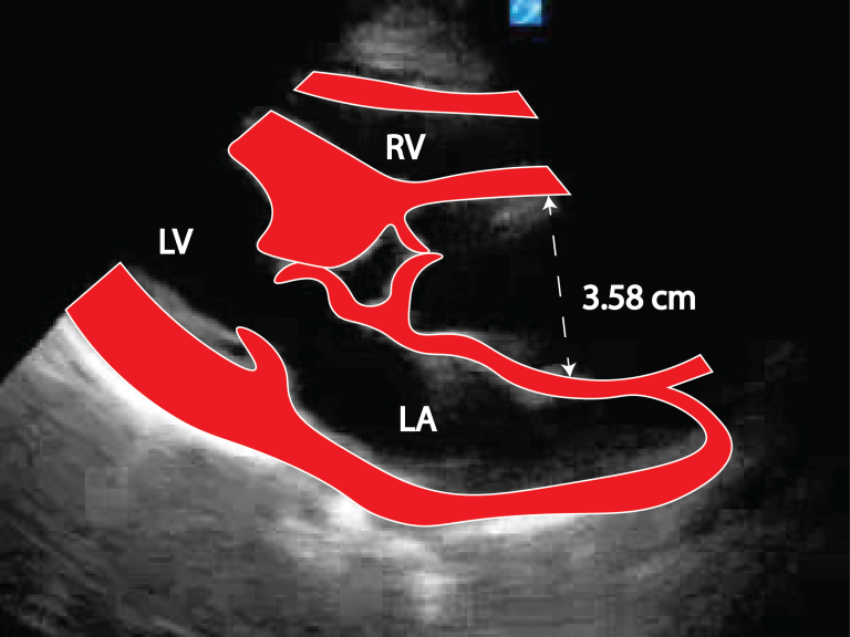 Discovering the aorta through ultrasound - Critical Care Sonography