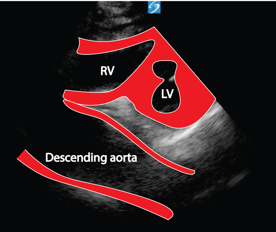Discovering the aorta through ultrasound - Critical Care Sonography