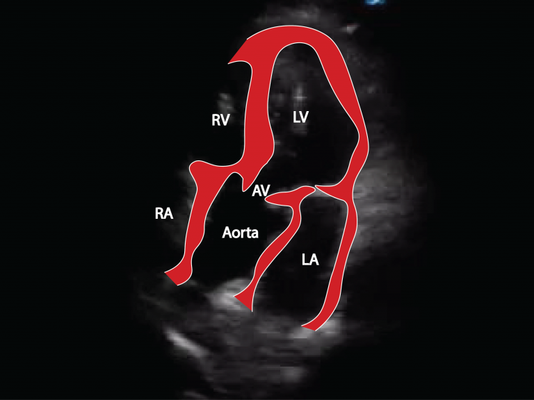 Discovering the aorta through ultrasound - Critical Care Sonography