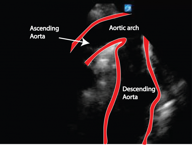 Discovering the aorta through ultrasound - Critical Care Sonography