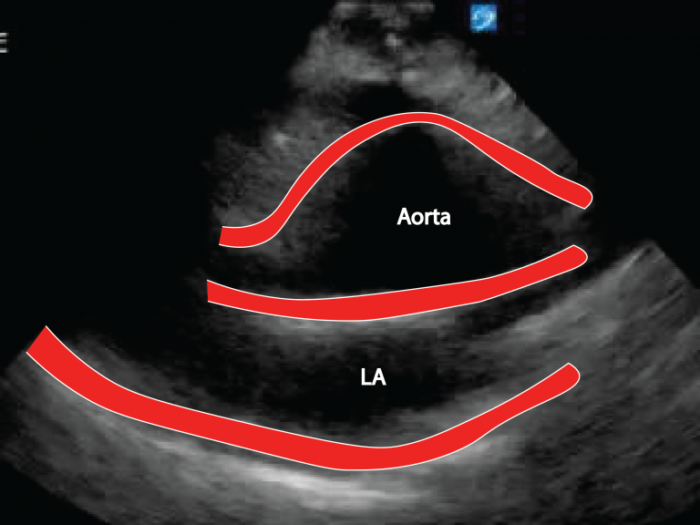 Discovering the aorta through ultrasound - Critical Care Sonography