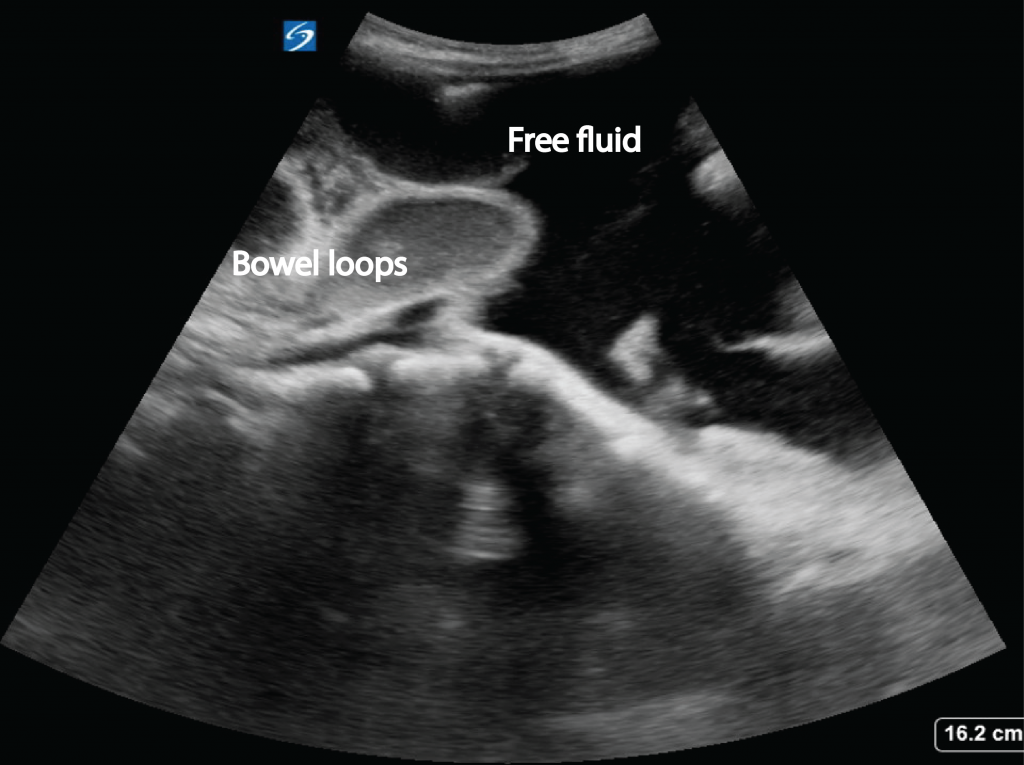 Internal hernia - Critical Care Sonography