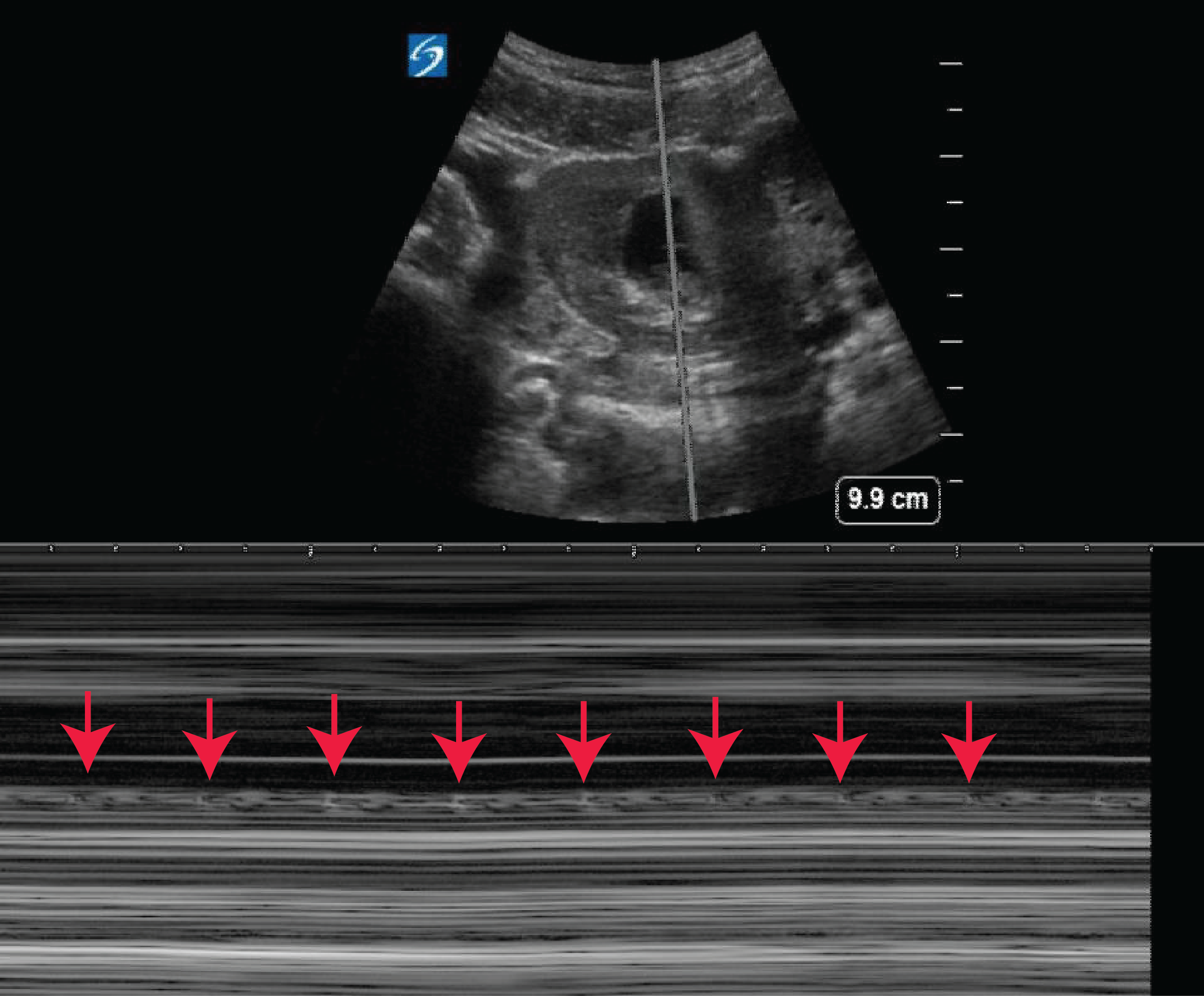 Early Pregnancy Fetal Heart Beat - Now you see it, now you don't ...