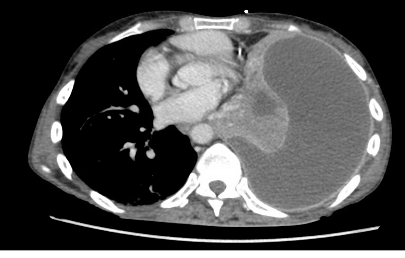 Empyema - Critical Care Sonography