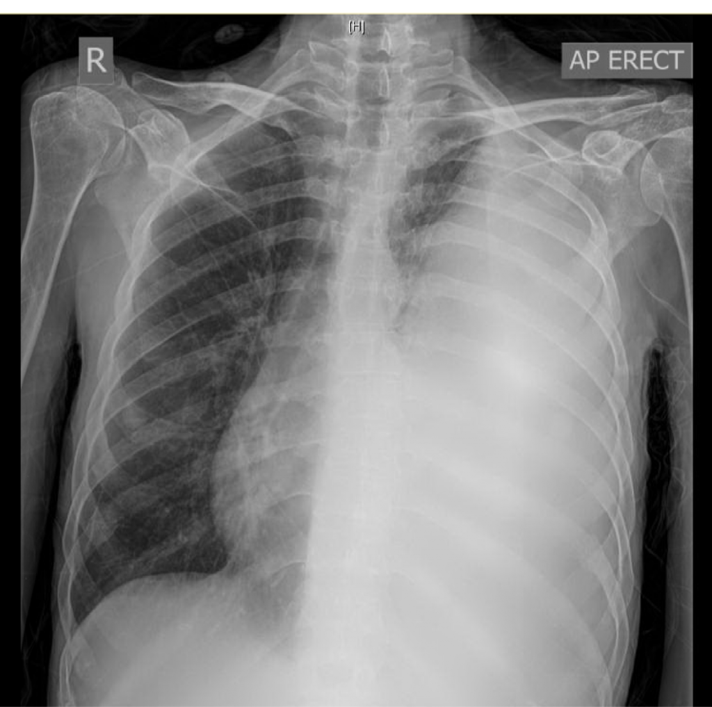 Empyema - Critical Care Sonography