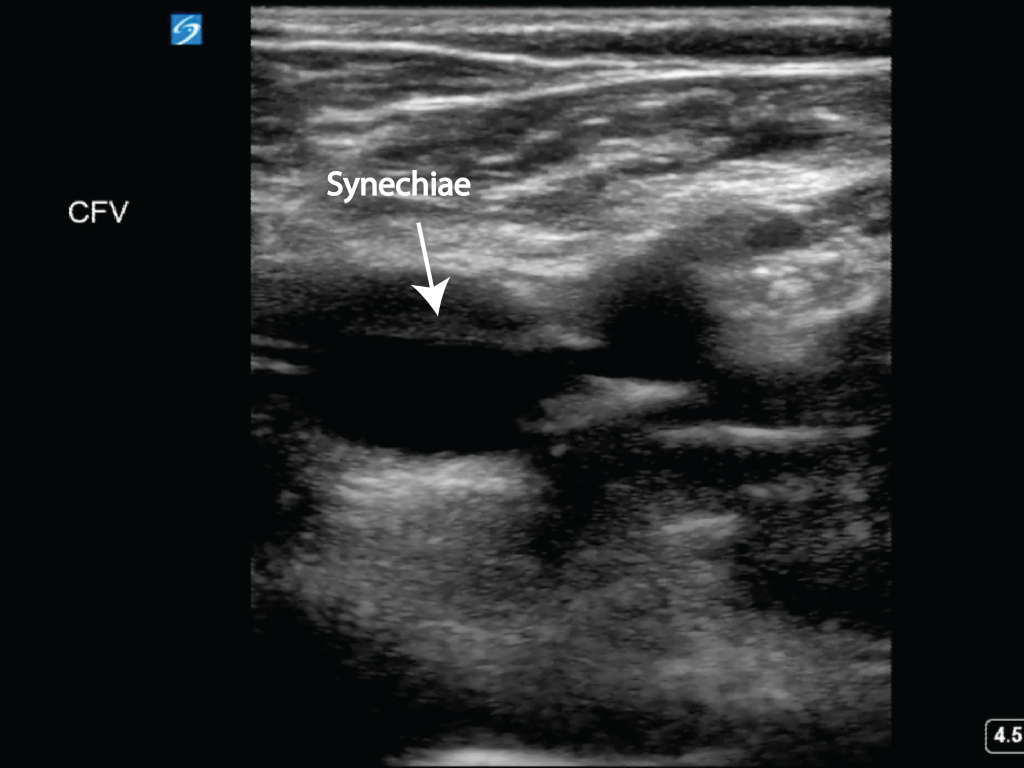 DVT - Why use Doppler? - Critical Care Sonography
