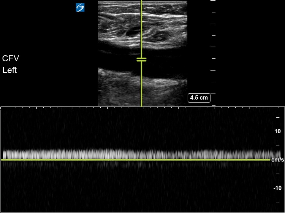 DVT - Why use Doppler? - Critical Care Sonography