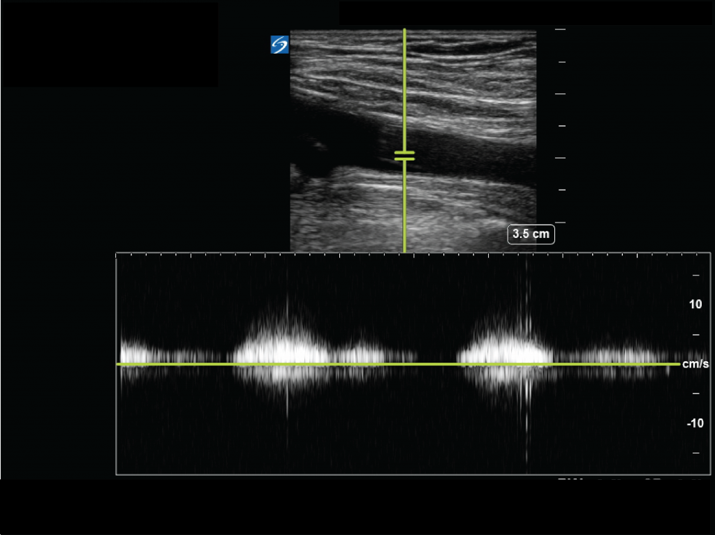 DVT - Why use Doppler? - Critical Care Sonography