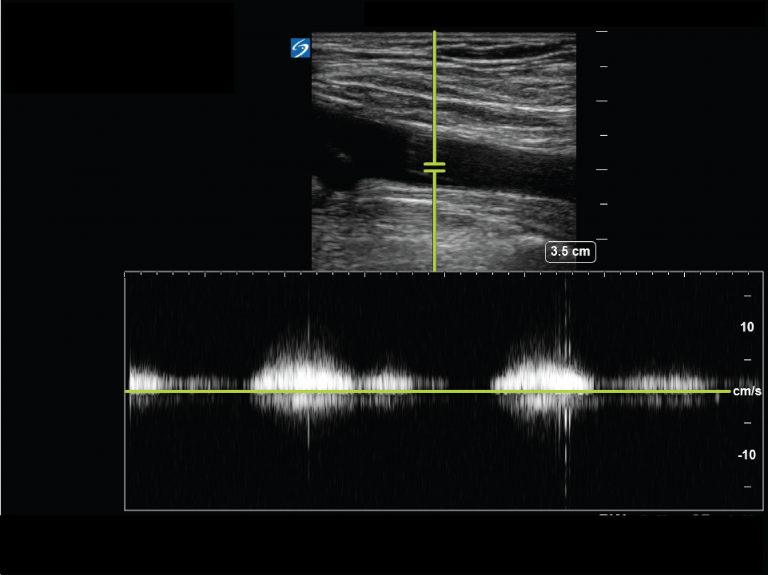 DVT - Why use Doppler? - Critical Care Sonography