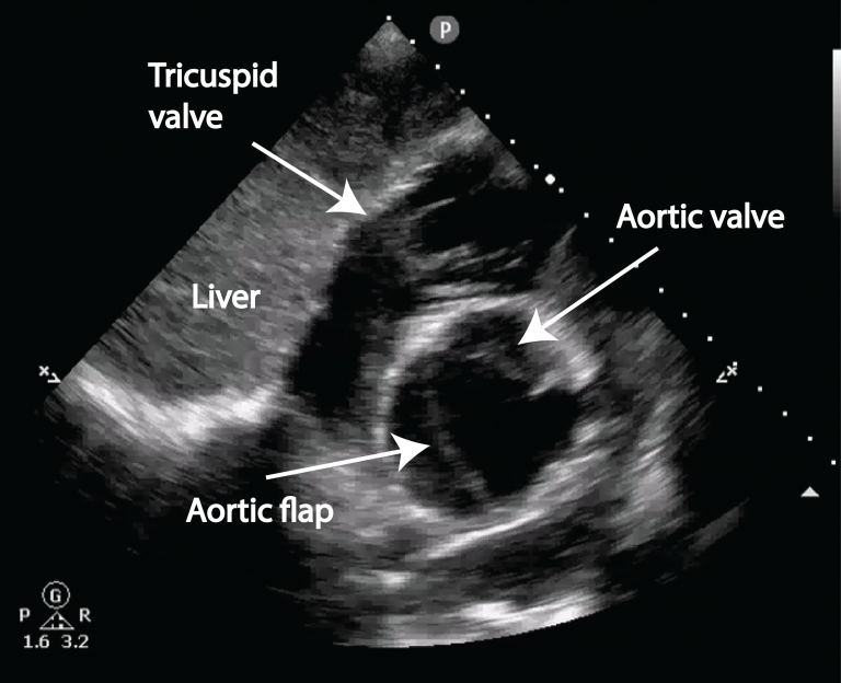 Aortic Dissection - Stanford Type A - Critical Care Sonography