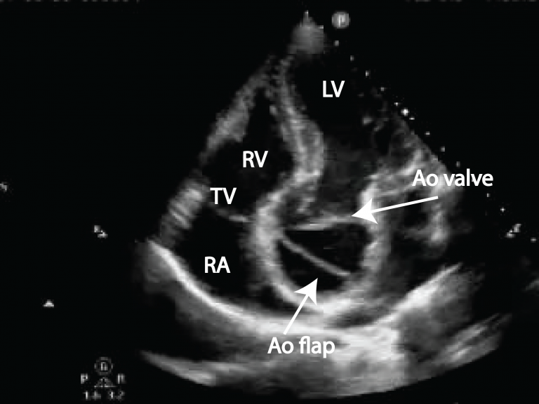 Aortic Dissection - Stanford Type A - Critical Care Sonography