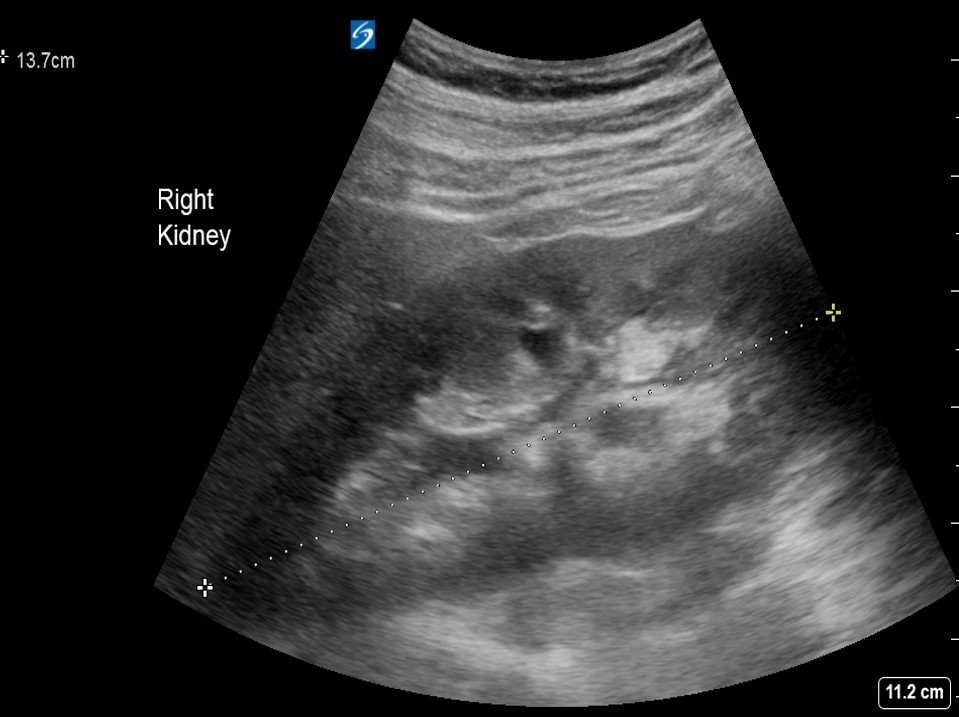 Renal colic - Critical Care Sonography