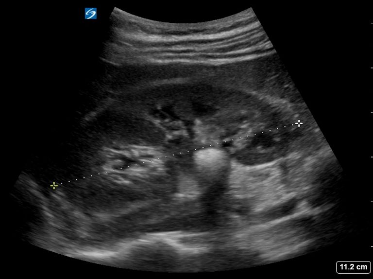 Renal colic - the twinkle artifact - Critical Care Sonography