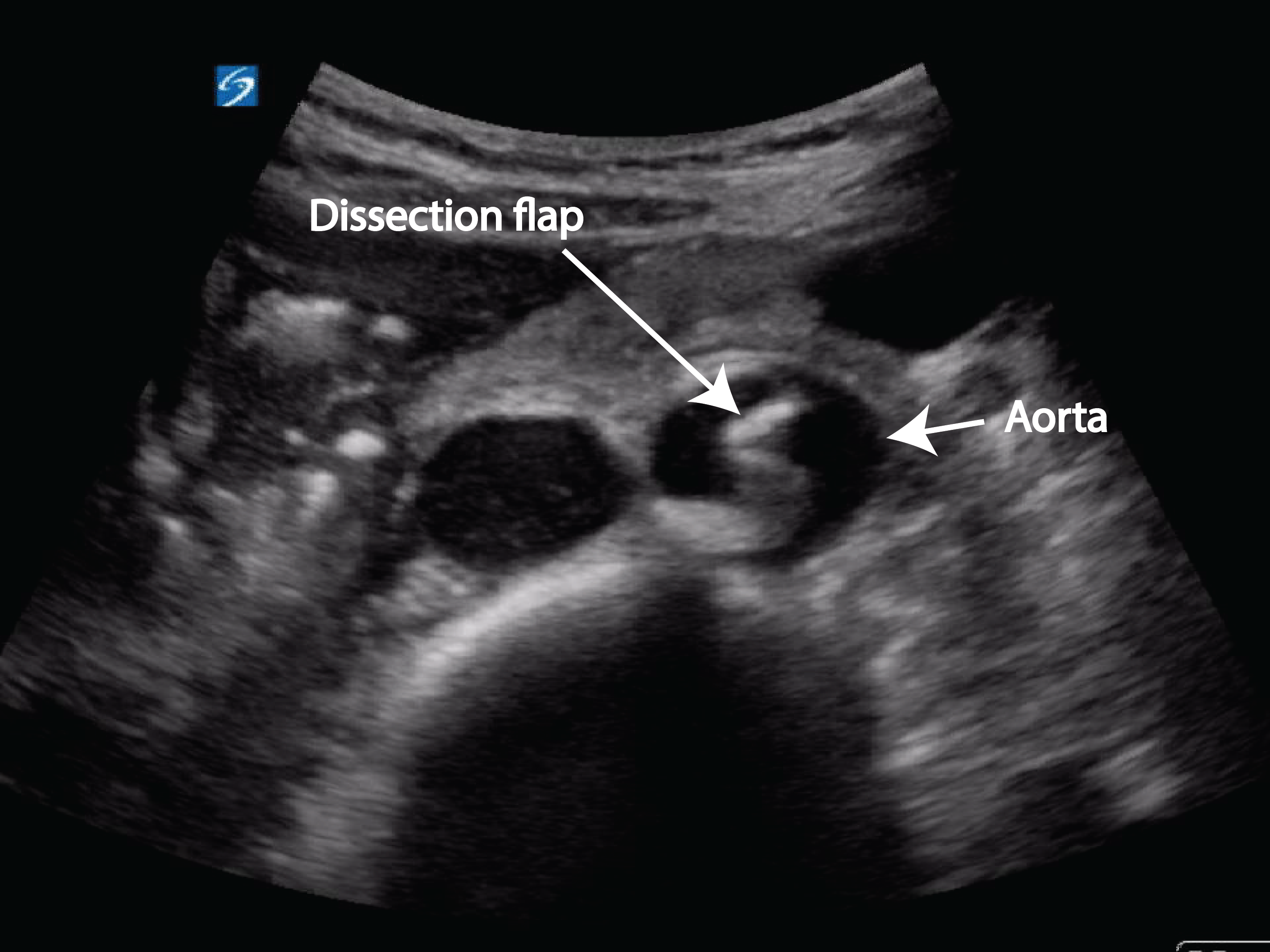 Cardiac arrest : Aortic dissection - Critical Care Sonography