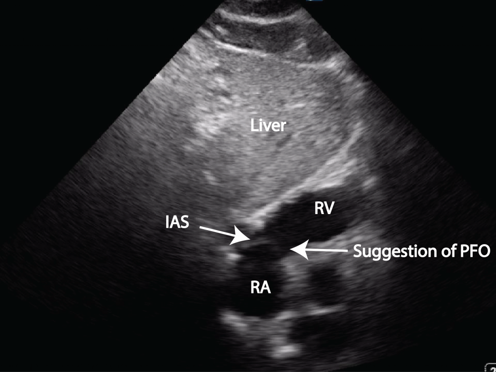 PFO - Critical Care Sonography