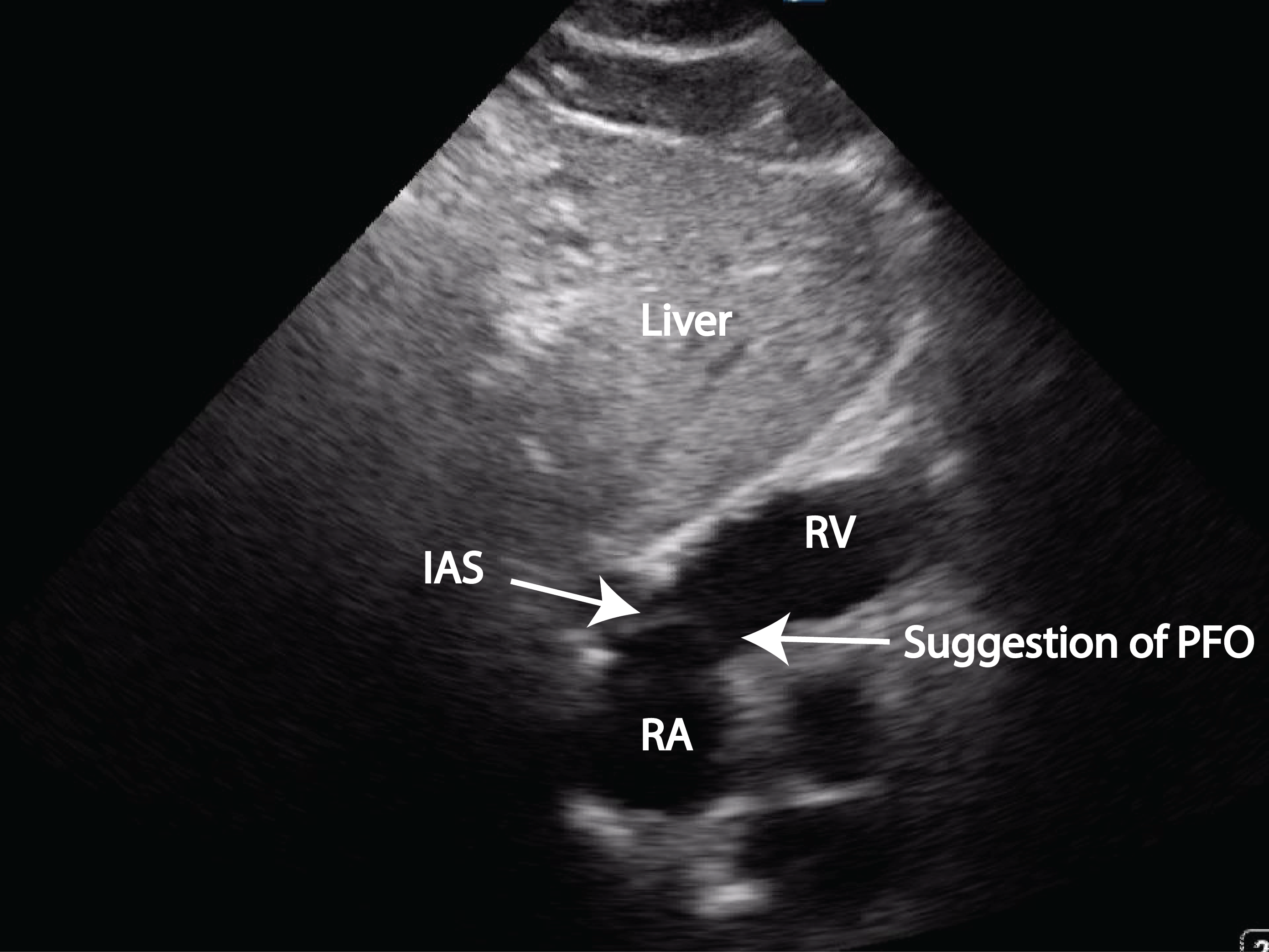 PFO - Critical Care Sonography
