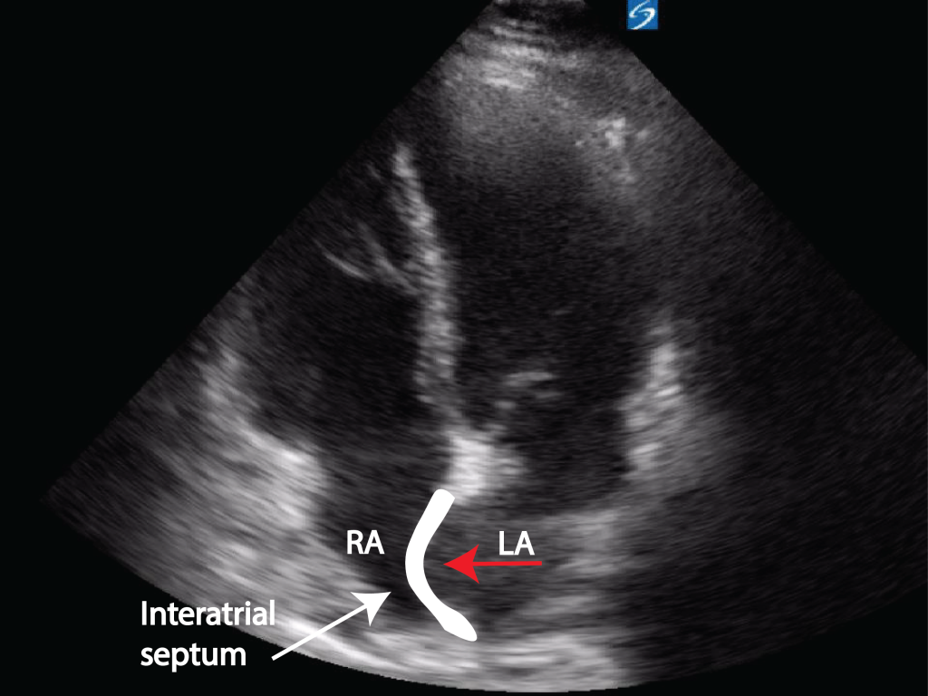 PFO - Critical Care Sonography