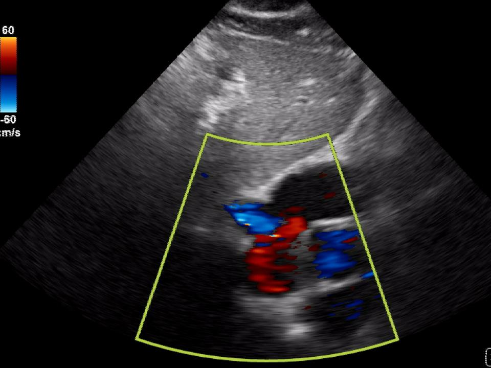 PFO - Critical Care Sonography