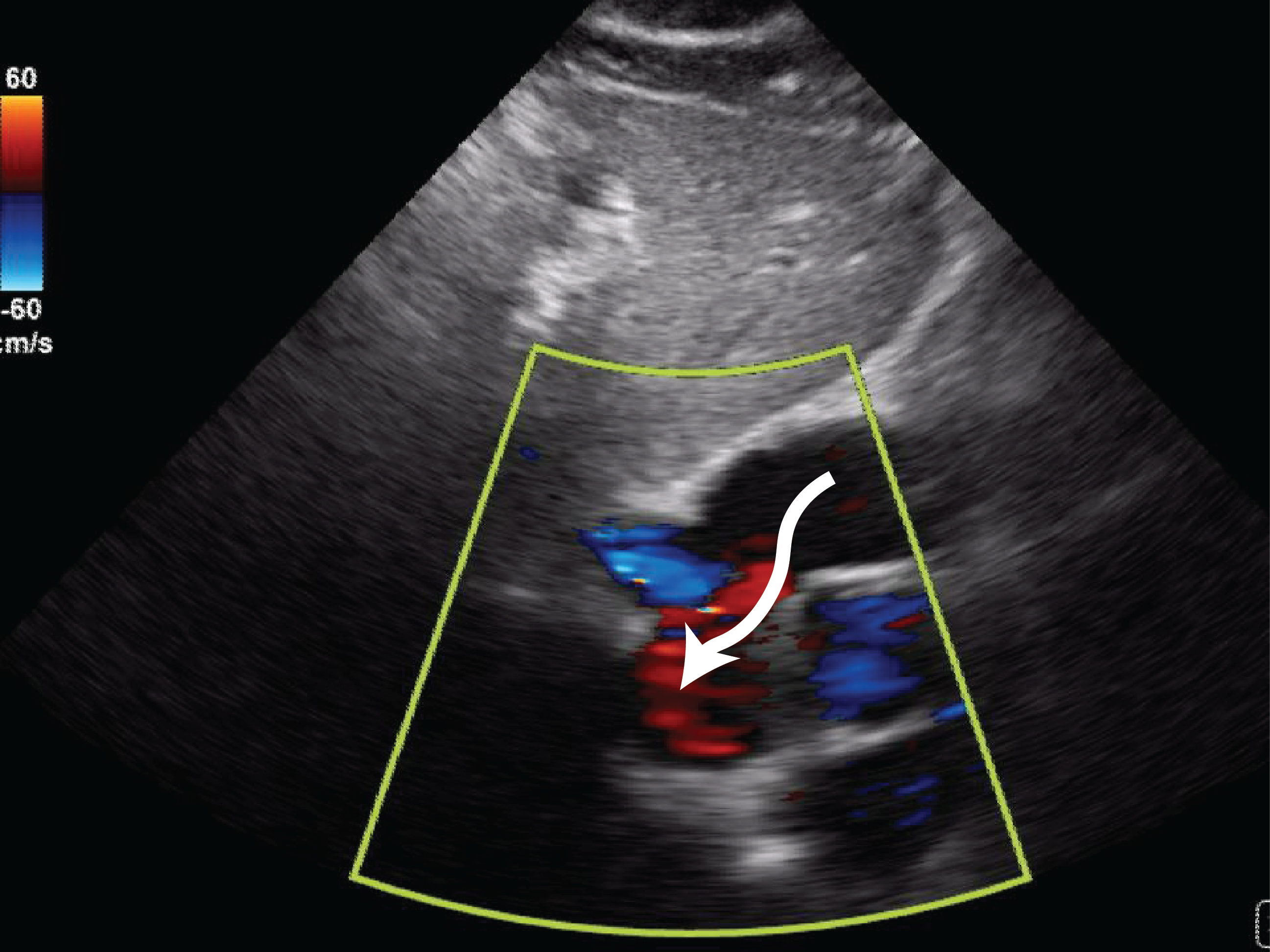 PFO - Critical Care Sonography