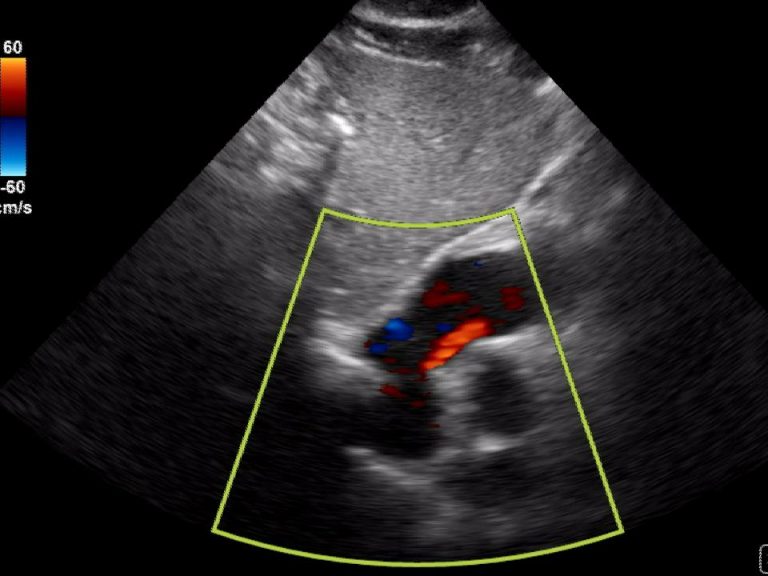 PFO - Critical Care Sonography