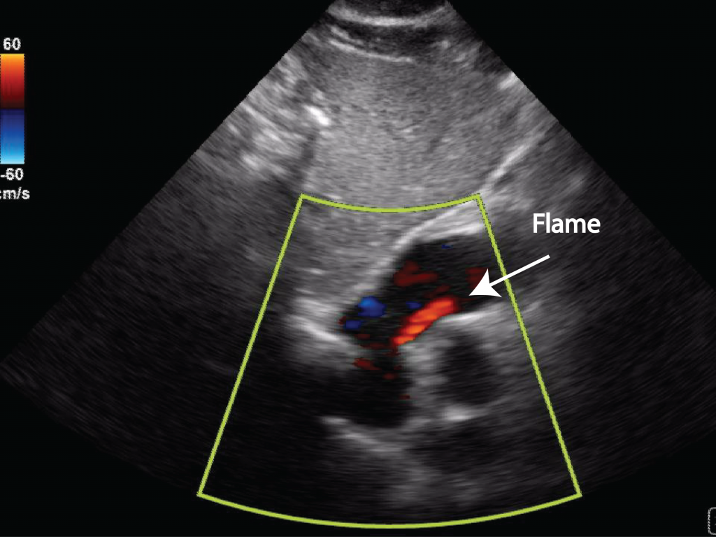 PFO - Critical Care Sonography