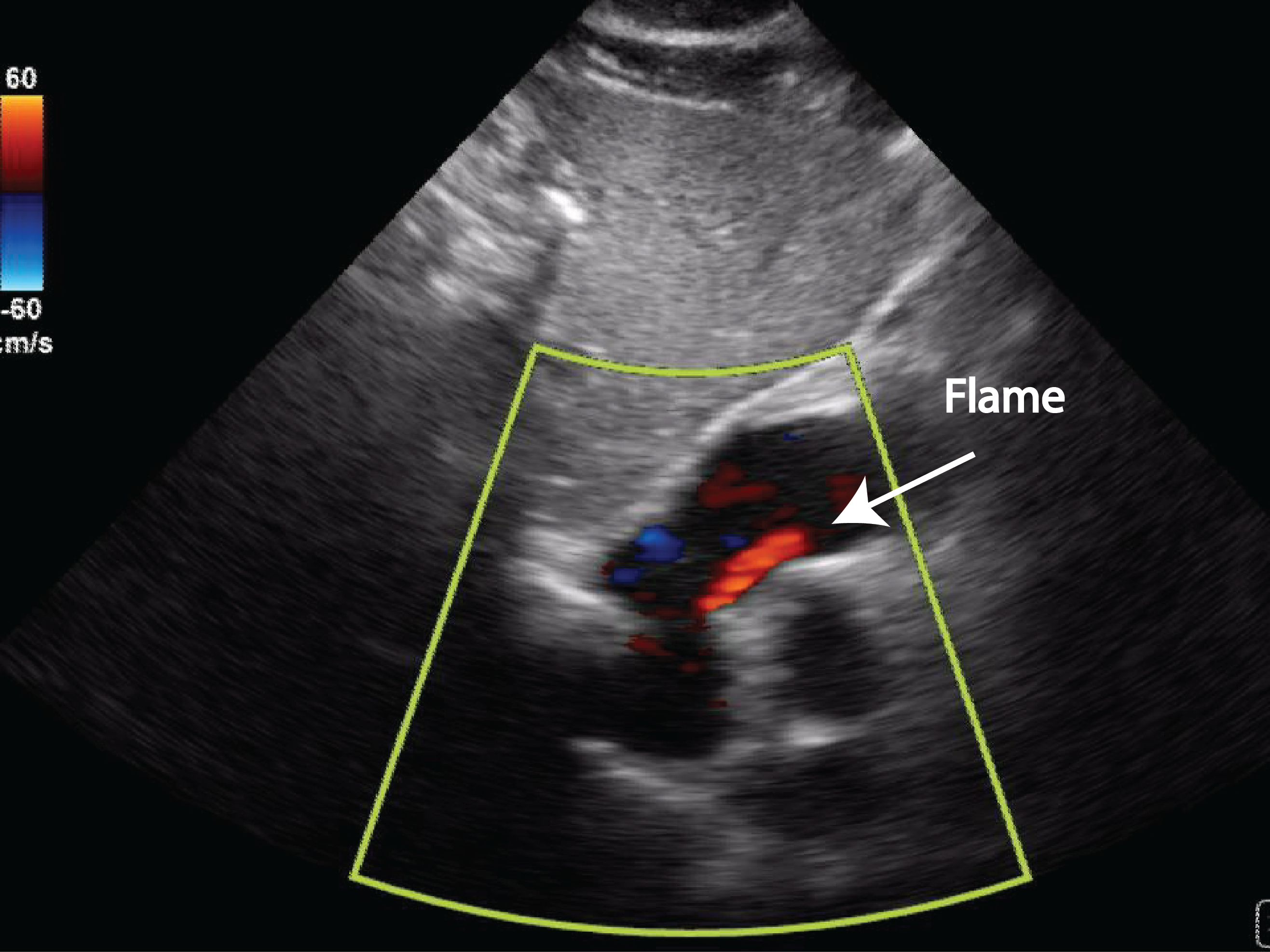 PFO - Critical Care Sonography