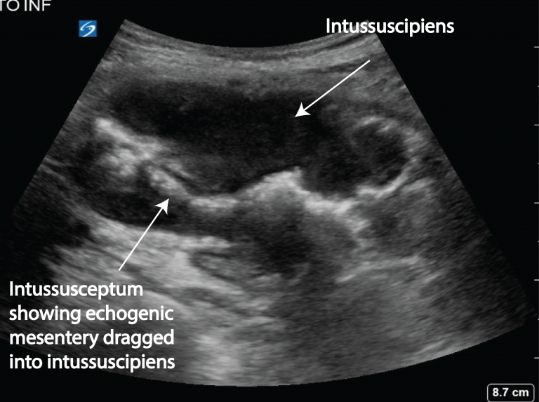 Intussusception: Left upper quadrant mass - Critical Care Sonography
