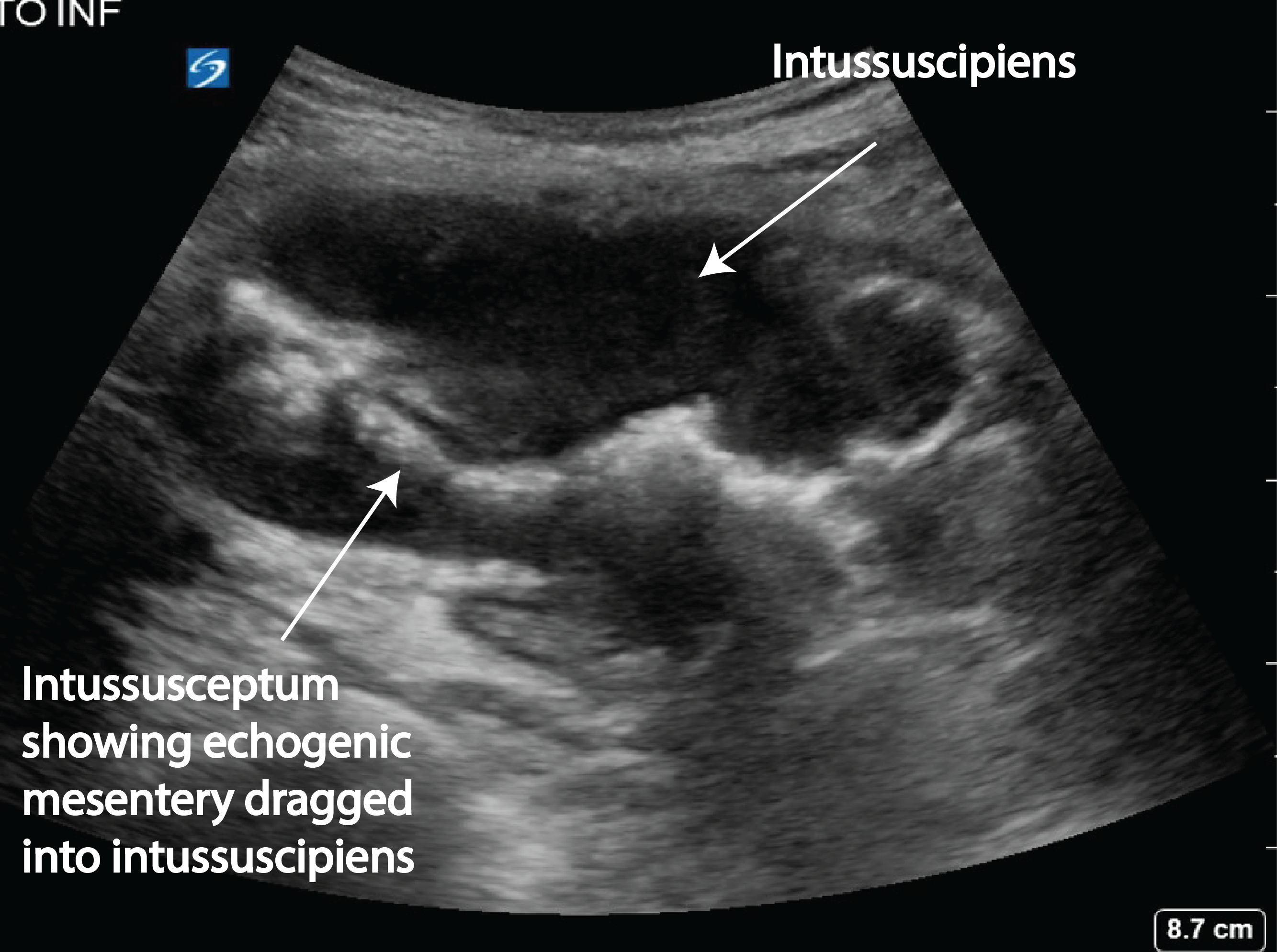 Intussusception: Left upper quadrant mass - Critical Care Sonography
