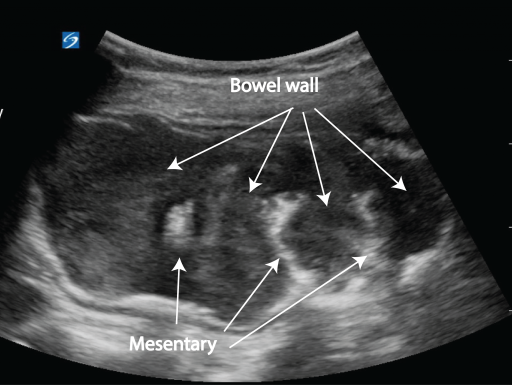 Intussusception: Left upper quadrant mass - Critical Care Sonography