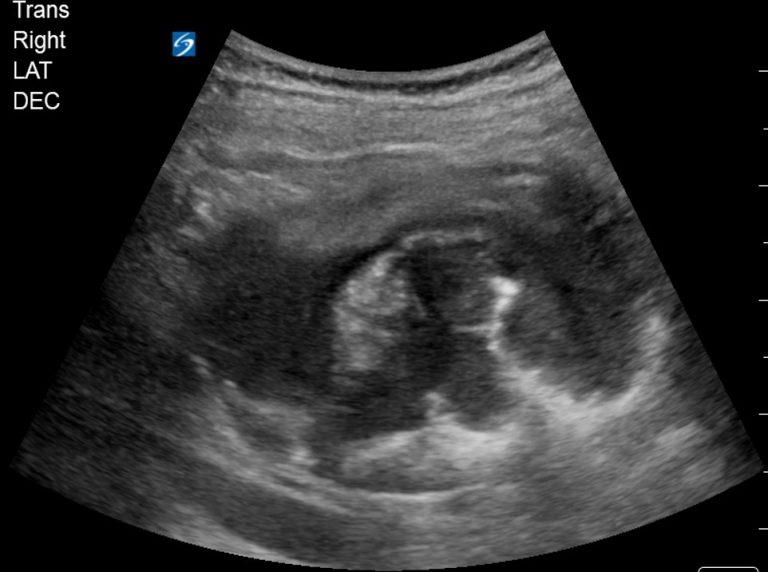 Intussusception: Left upper quadrant mass - Critical Care Sonography