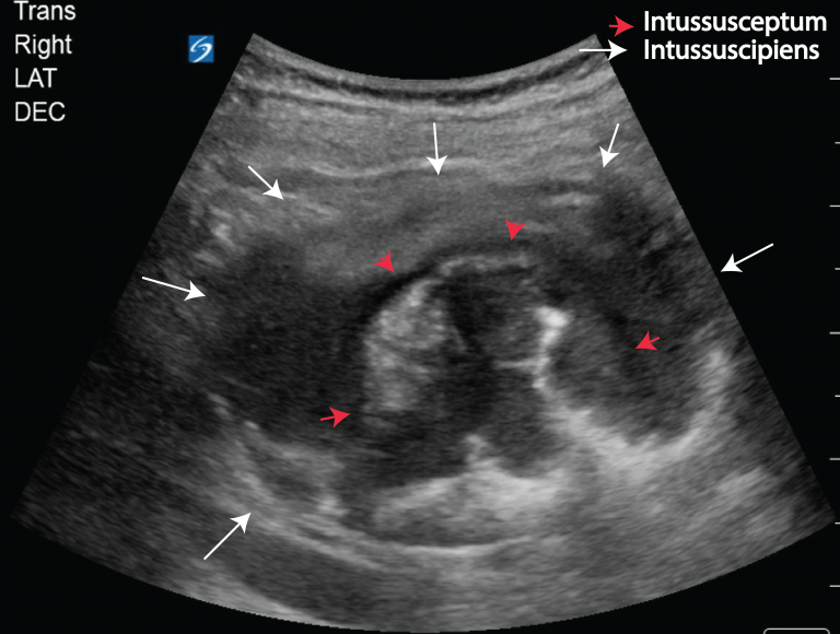 Intussusception: Left upper quadrant mass - Critical Care Sonography