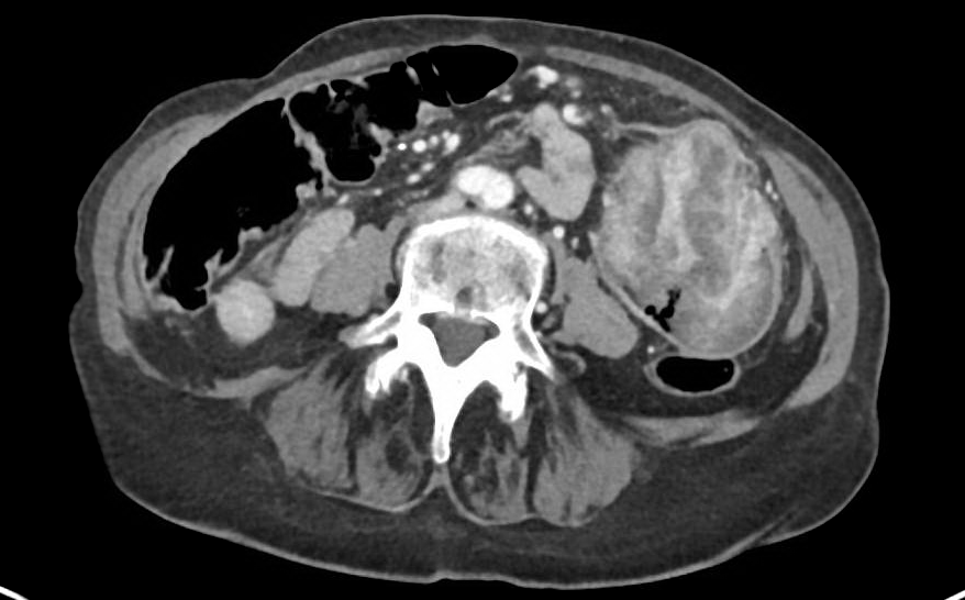 Intussusception: Left upper quadrant mass - Critical Care Sonography
